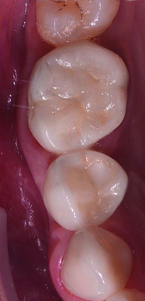 Dental News - Digital workflow and application of PRF and ozone therapy ...