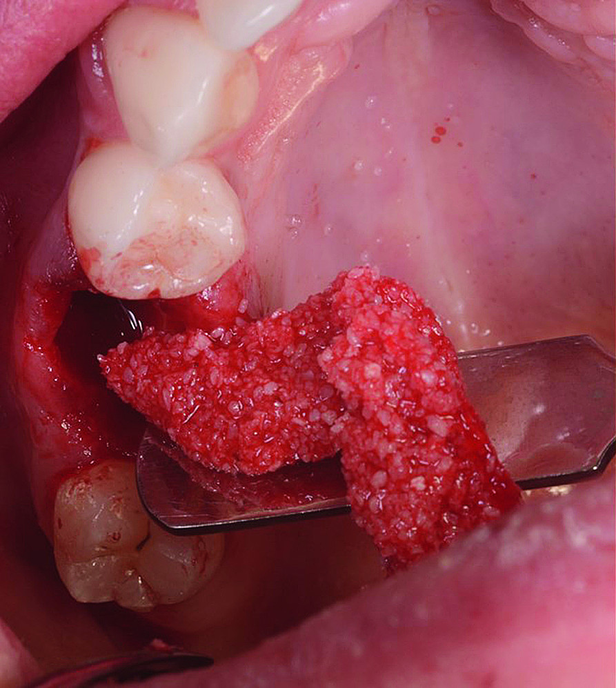 Dental News - Digital workflow and application of PRF and ozone therapy ...