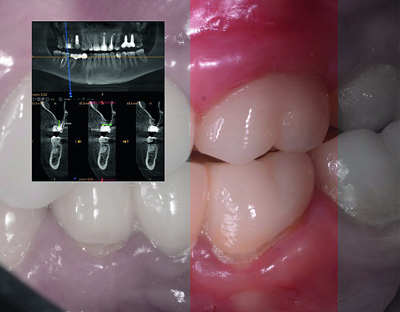 Dental News - Digital workflow and application of PRF and ozone therapy ...
