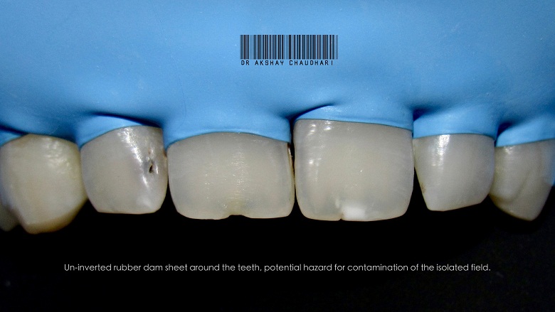 DT News - India - Rubber dam- Ace the basics