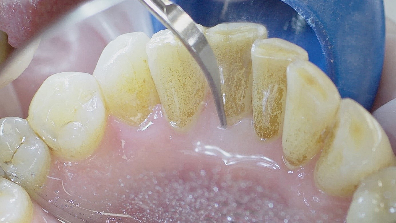 Dental News - Implants should only be inserted when periodontal ...