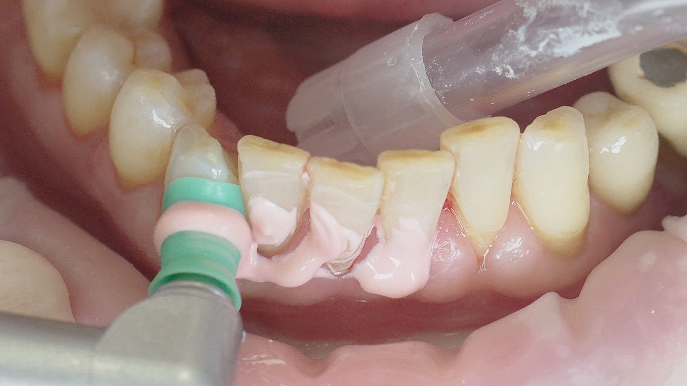 Dental News - Implants should only be inserted when periodontal ...