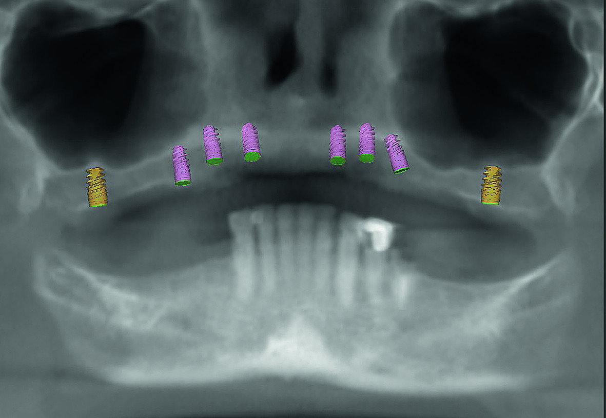 Dental News - Incorporating CAD/CAM solutions for full-mouth dental ...