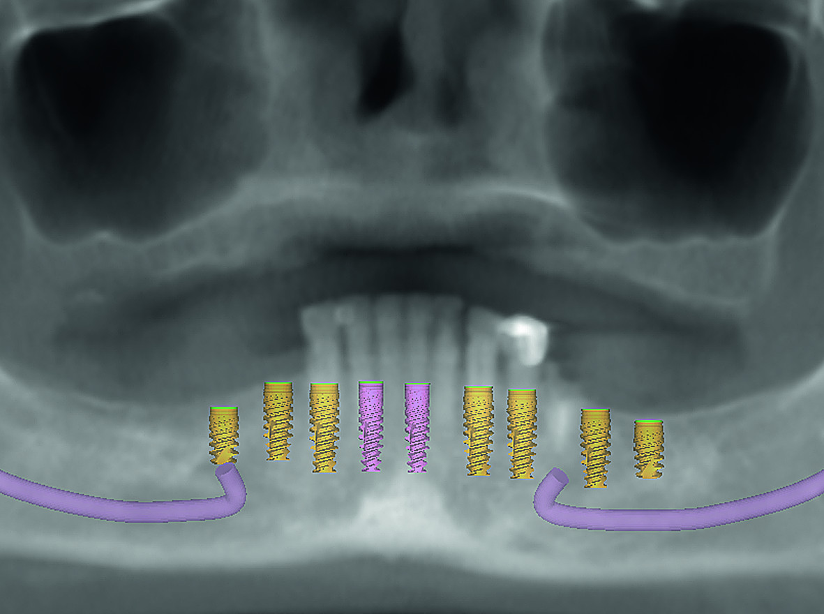 Dental News - Incorporating CAD/CAM solutions for full-mouth dental ...