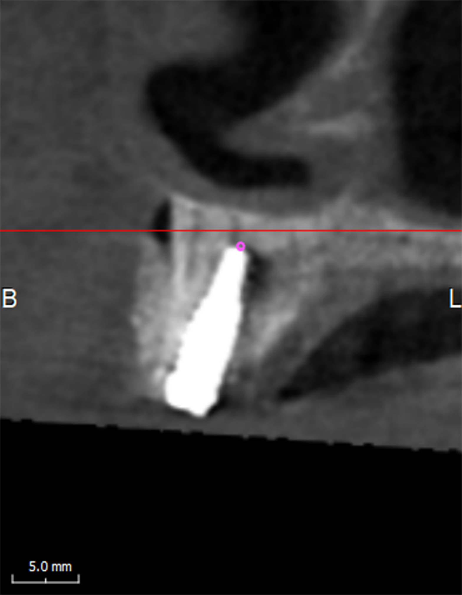 DT News - Italy - Il Canalis Sinuosus: una struttura anatomica da ...