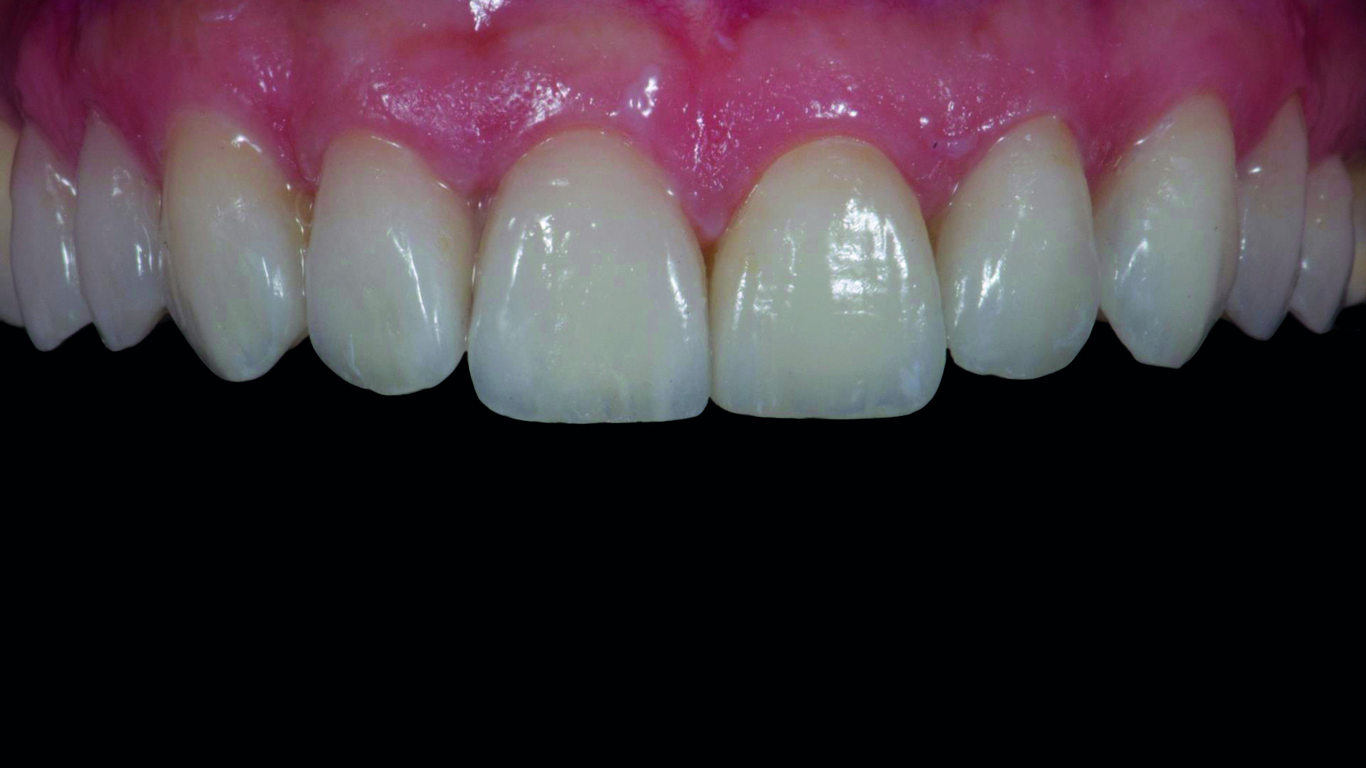 Dental News - Digital vs. analogue workflow on ten ceramic veneers in ...