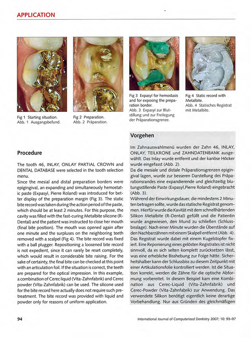 Efficient Dynamic Registration Technique Using Metal Bite.