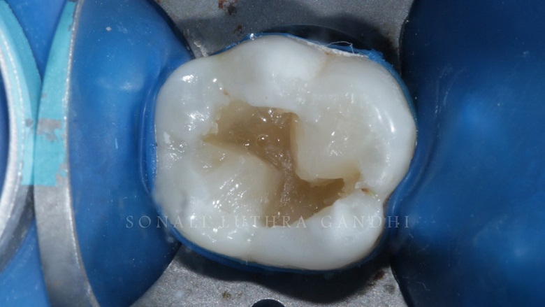 DT News - India - Cuspal layering technique to produce aesthetic ...