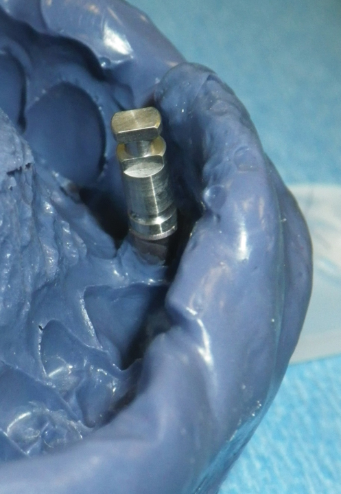 DT News - MEA - Predictable implant impressions