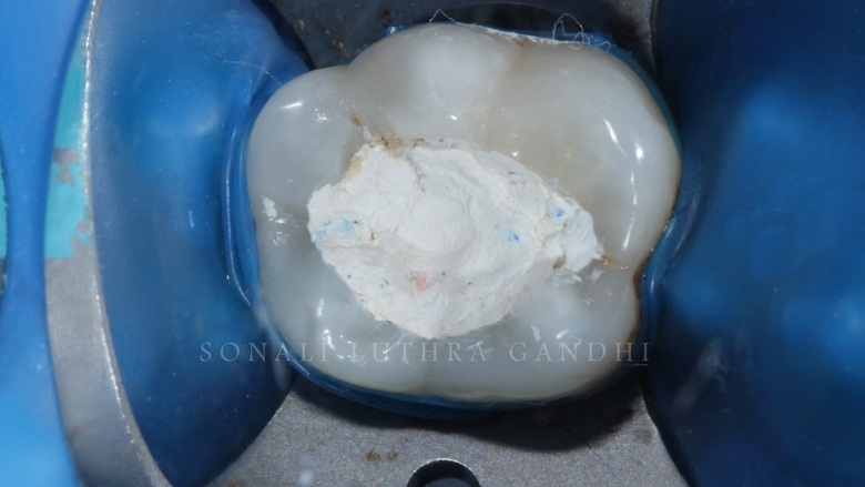 DT News - India - Cuspal layering technique to produce aesthetic ...