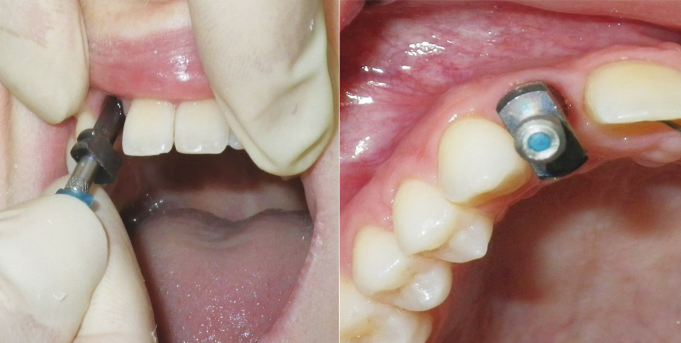 DT News - MEA - Predictable implant impressions