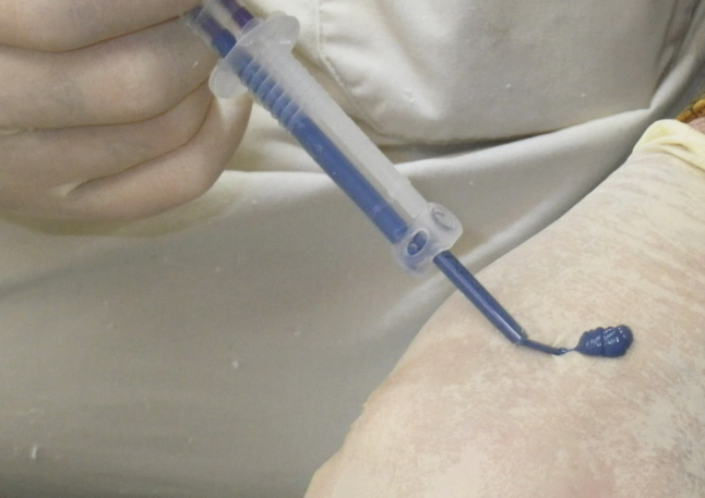 DT News - MEA - Predictable implant impressions