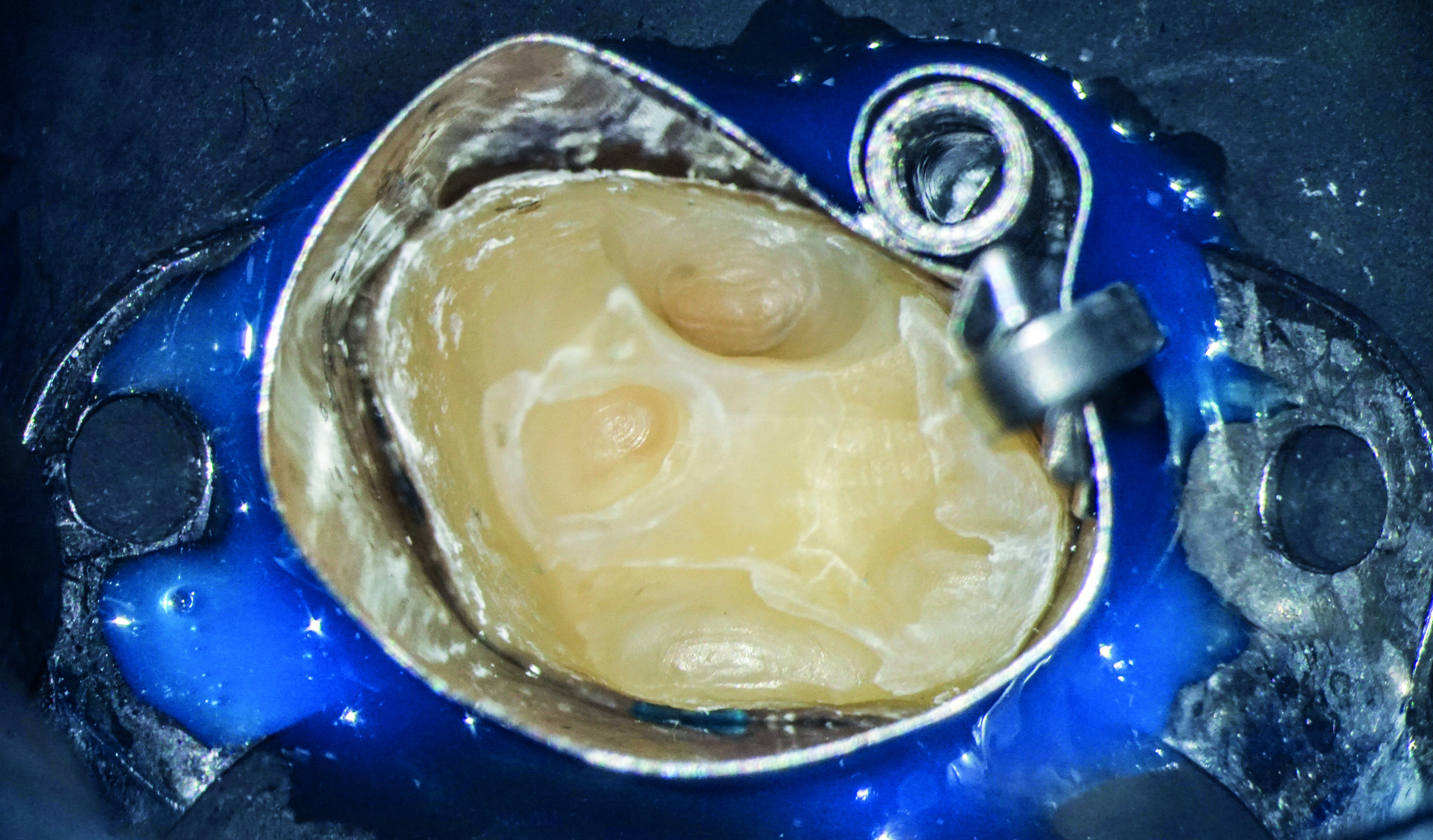 Dental News - Minimally invasive root canal shaping—A new protocol