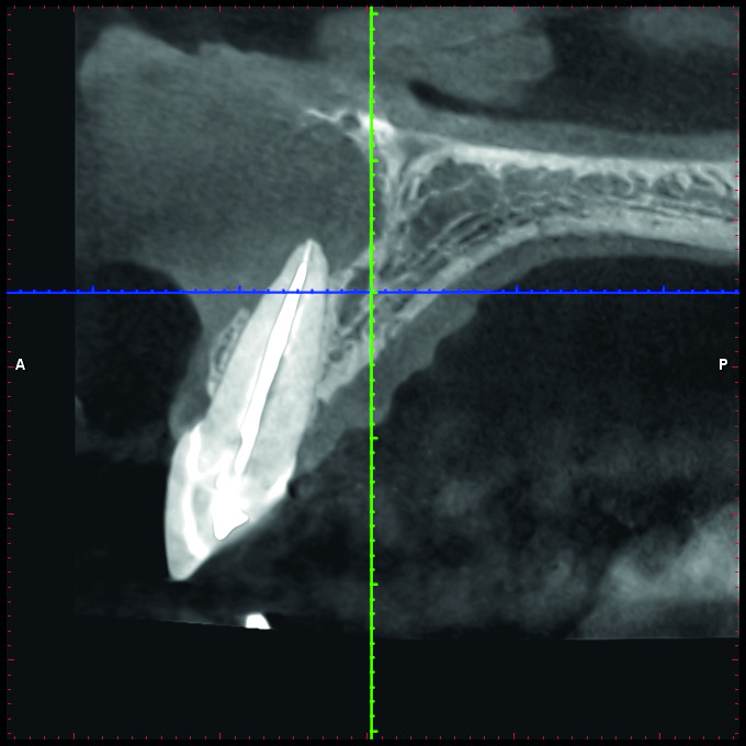 Dental News - Apical lesions: To treat or not to treat?