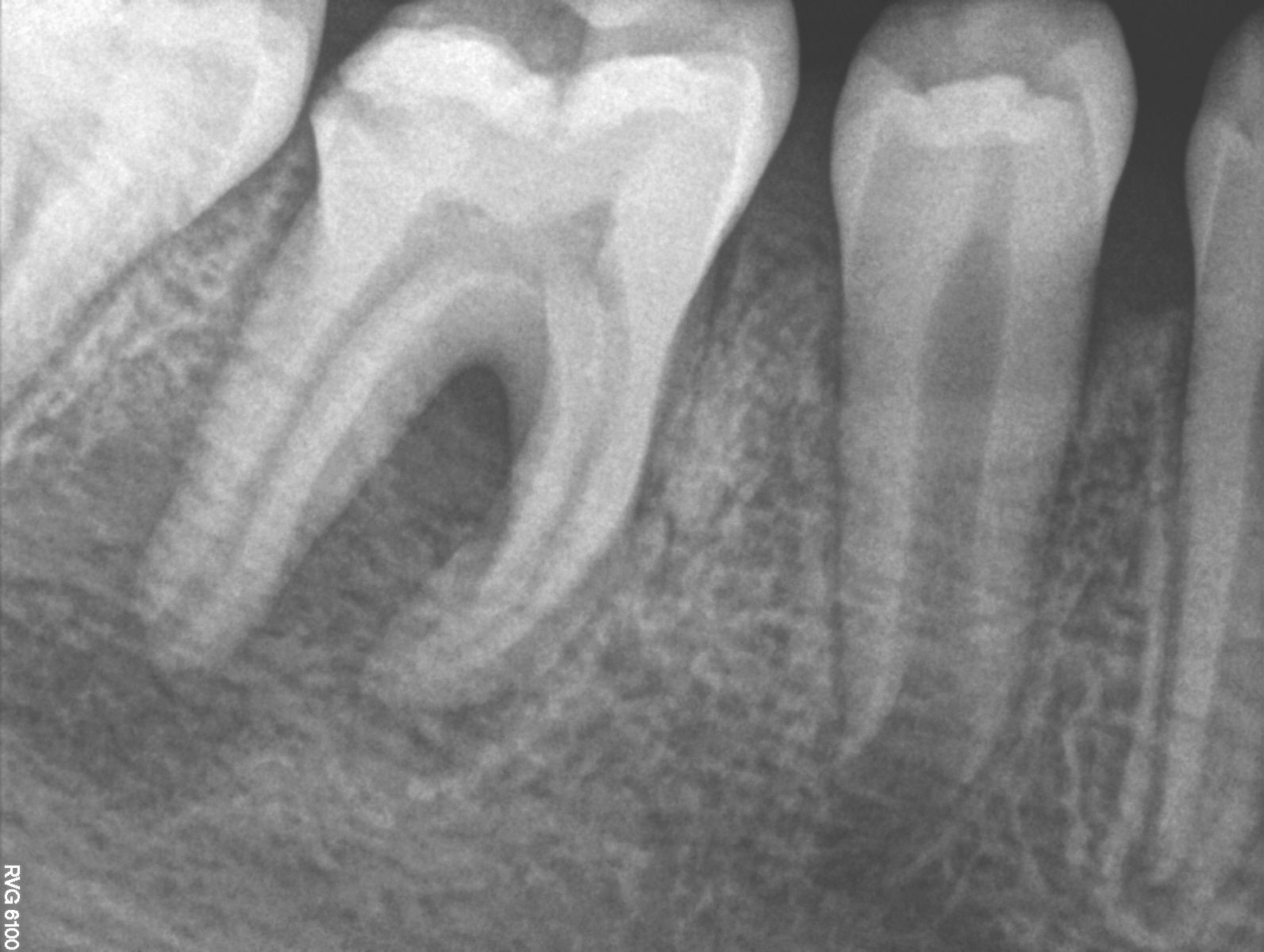 Dental News - Apical lesions: To treat or not to treat?