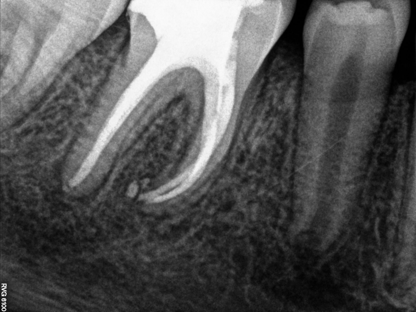 Dental News - Apical lesions: To treat or not to treat?