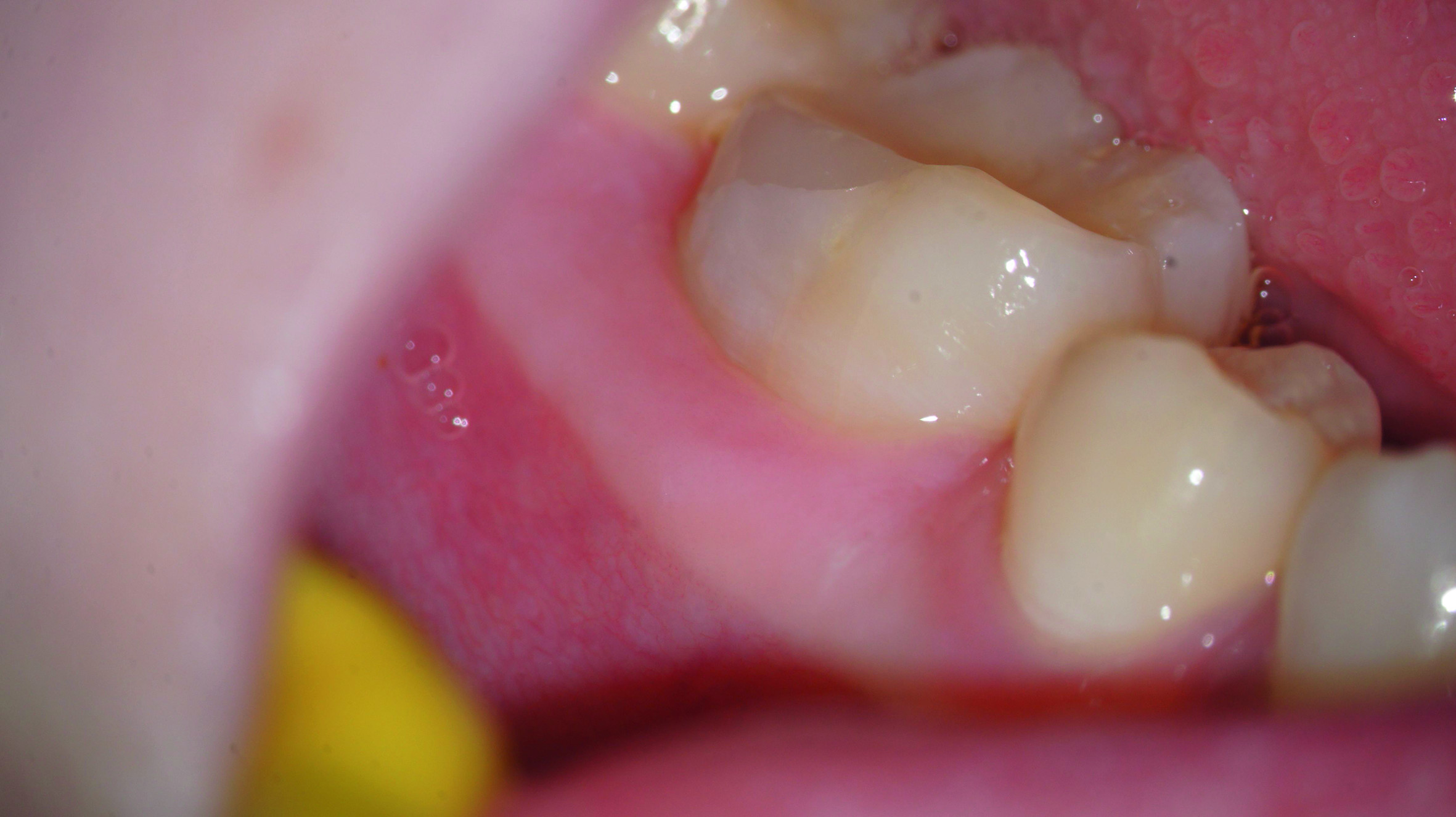 Dental News - Apical lesions: To treat or not to treat?