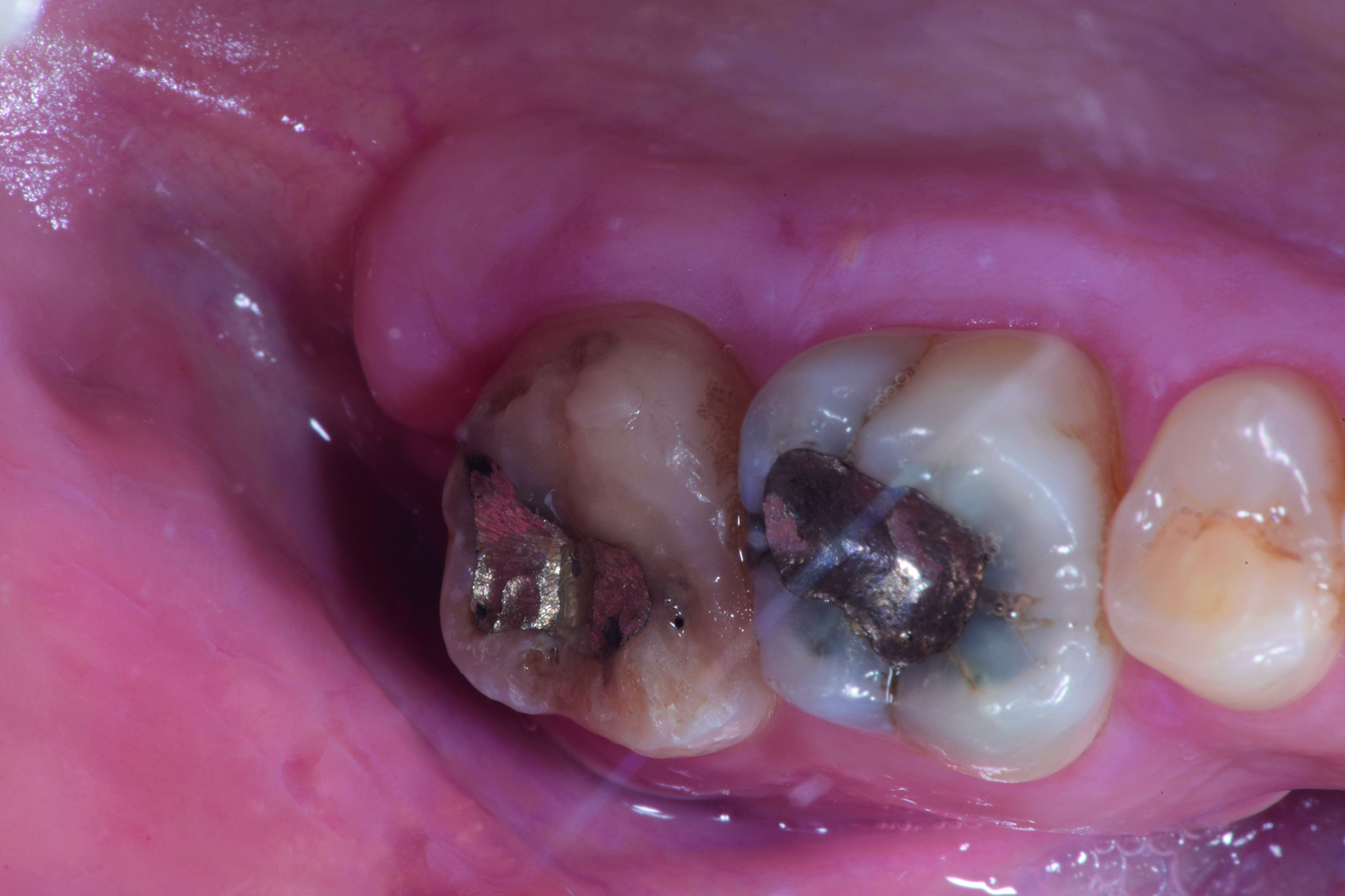 Dental News - How to give a second life to third molars: A case series ...