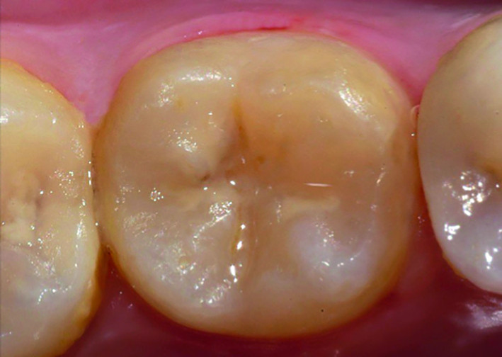 Dental News - How to give a second life to third molars: A case series ...