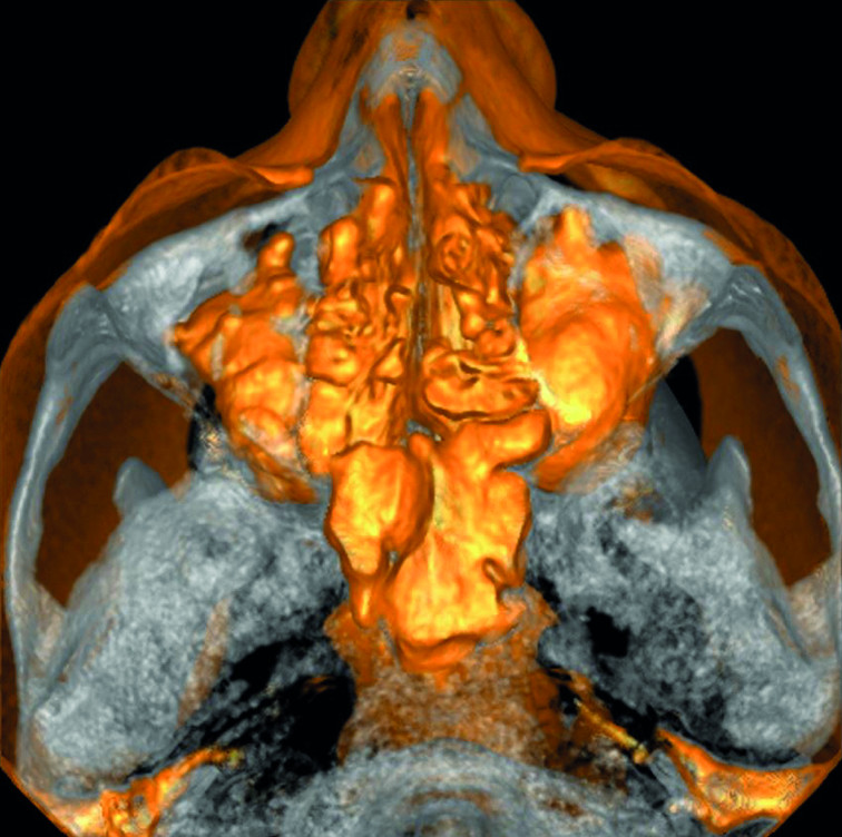 Dental News - Maxillary sinus and root canal therapy complications