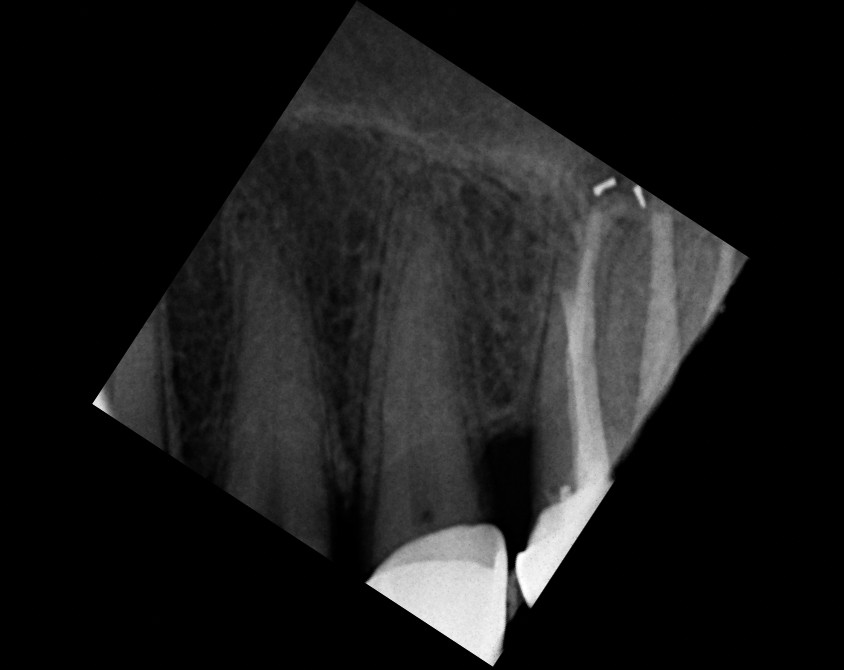 Dental News - Maxillary sinus and root canal therapy complications
