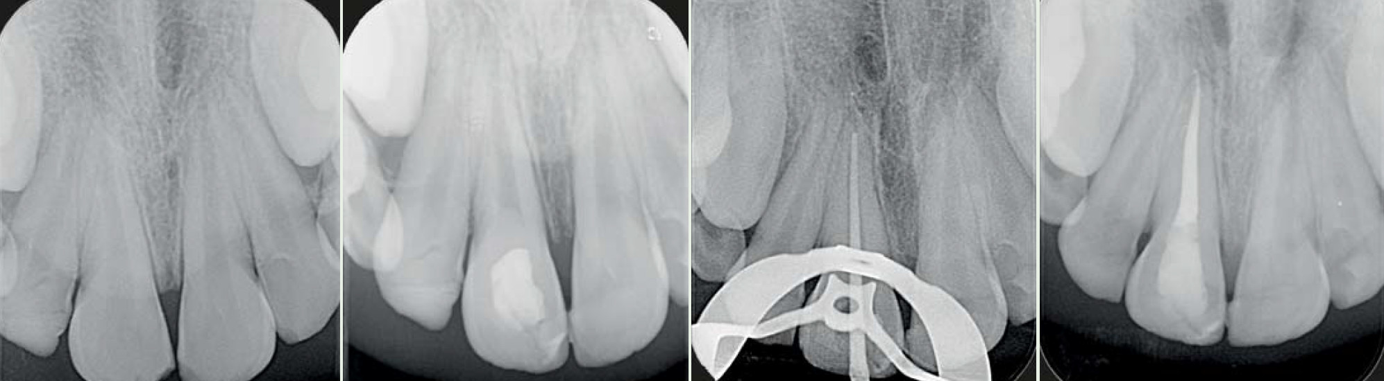 DT News - France - Le système Genius : moteur et limes pour mouvement ...
