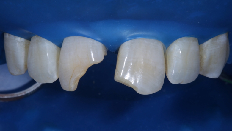 DT News - India - Bringing anterior direct composite restorations to ...