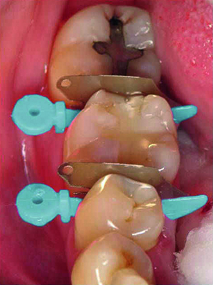 DT News - MEA - A clinical case using the Palodent® V3 Sectional Matrix ...