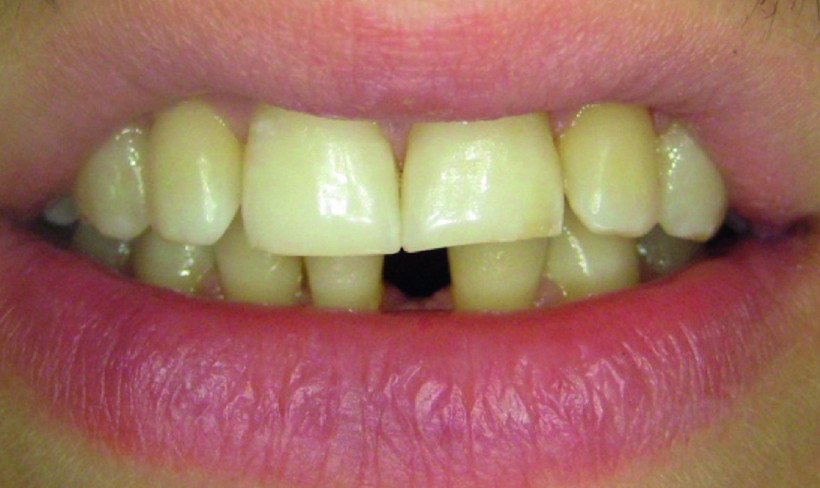 Dental News - Optical impression and provisional prosthesis: Proposal ...