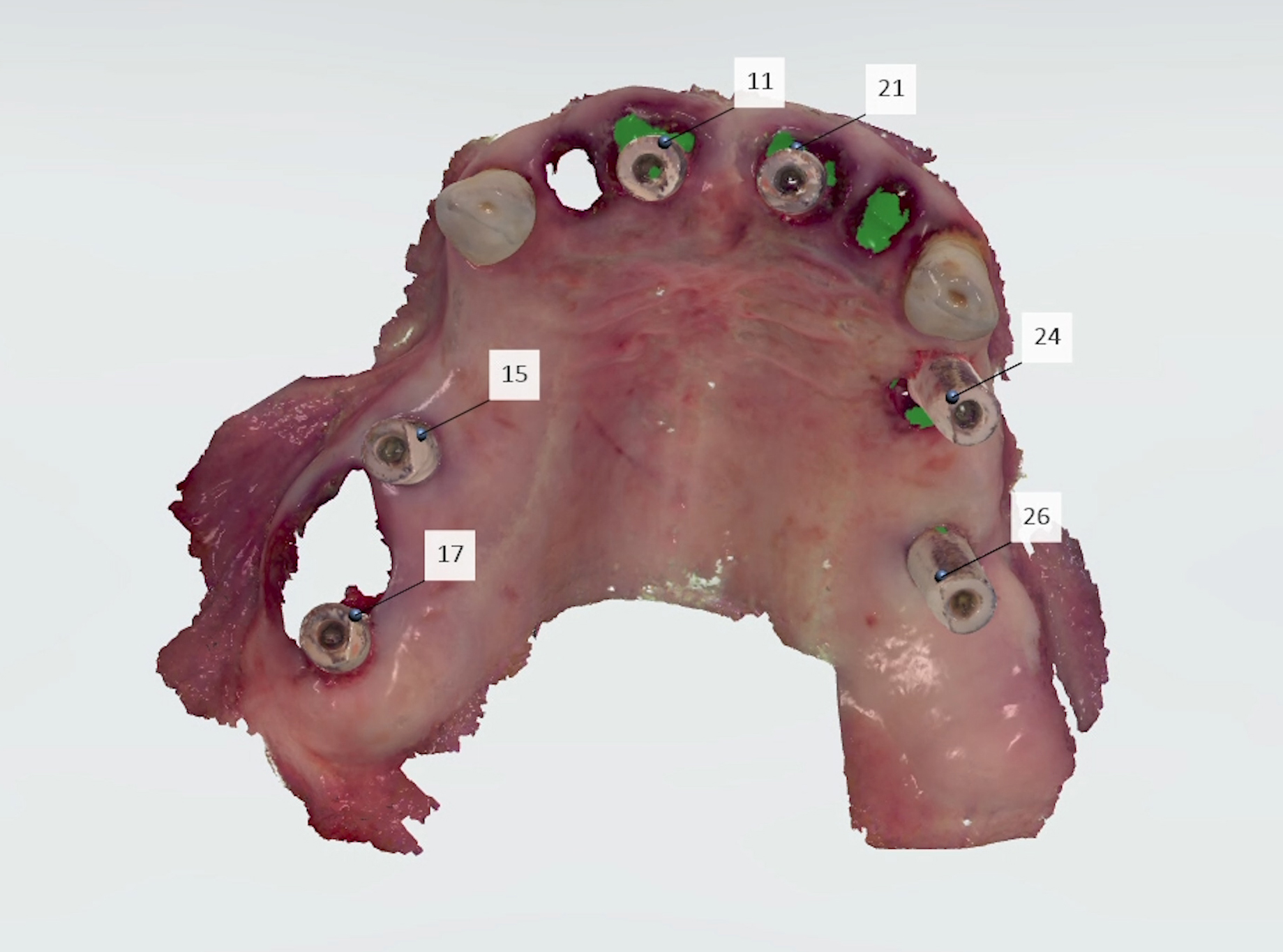 Dental News - The fully digital Pro Arch protocol