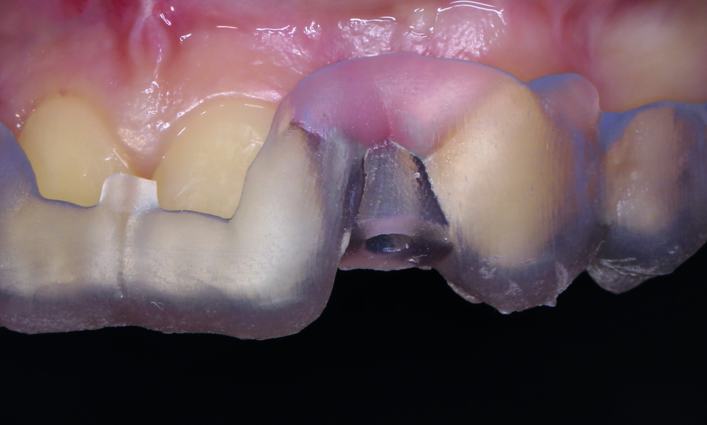 Dental News - The complete digital implant workflow