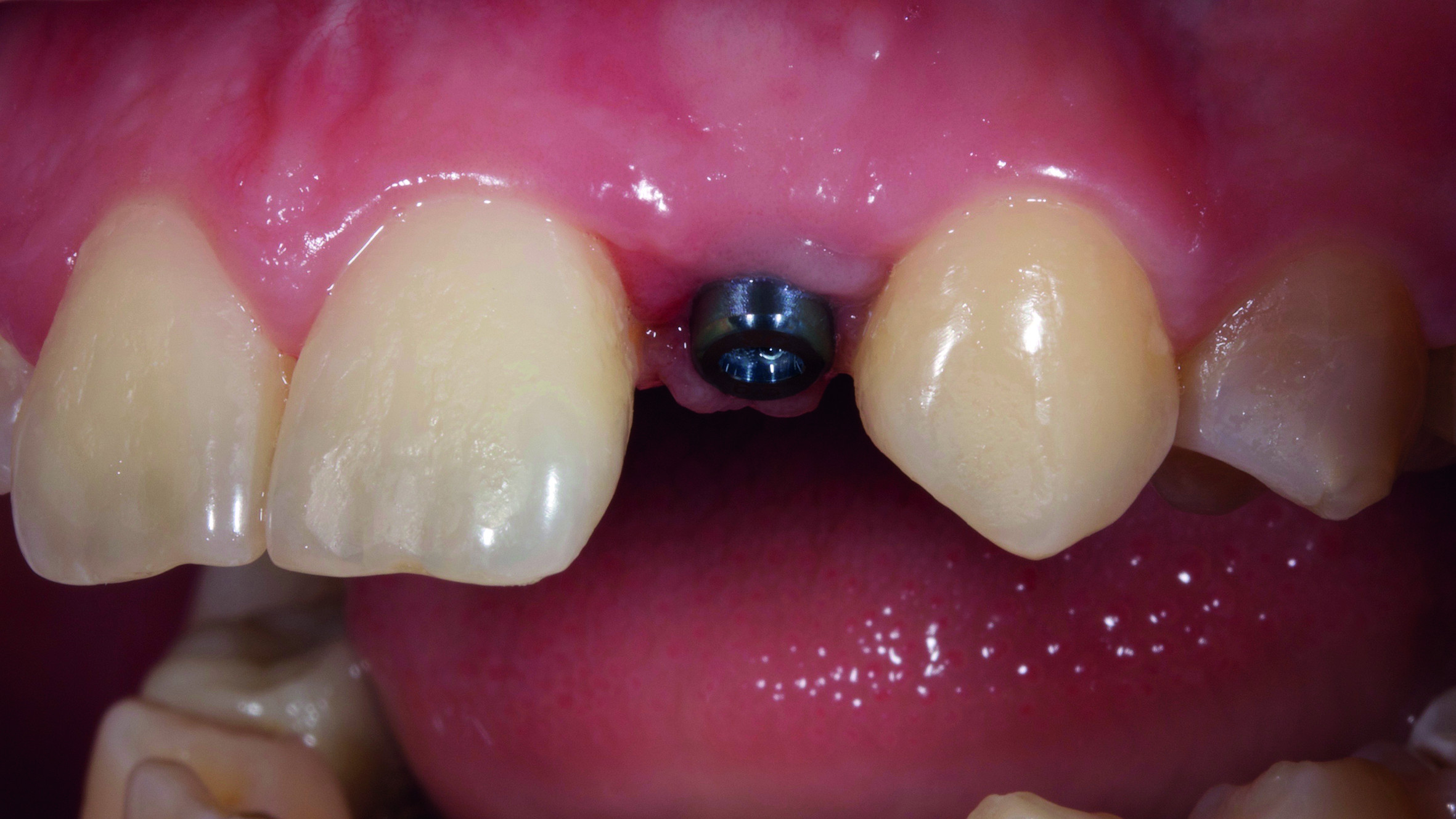 Dental News - The complete digital implant workflow