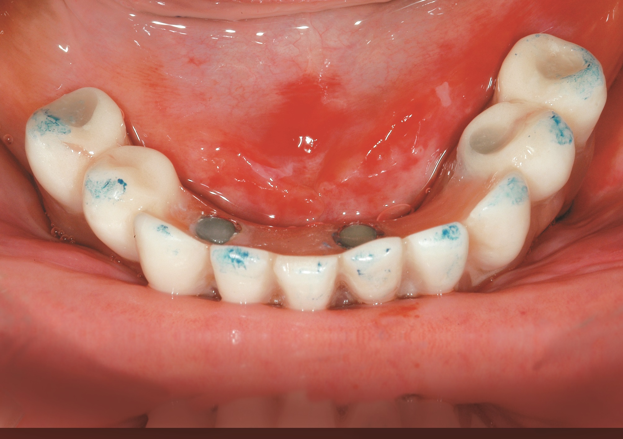 Occlusione su impianti