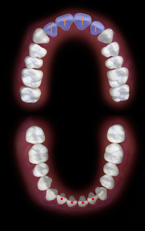 Occlusione su impianti