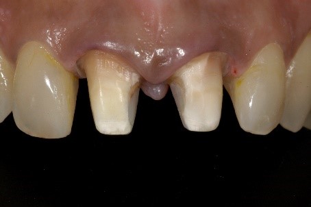 DT News - India - Knife-edges are back, thanks to adhesive tech ...