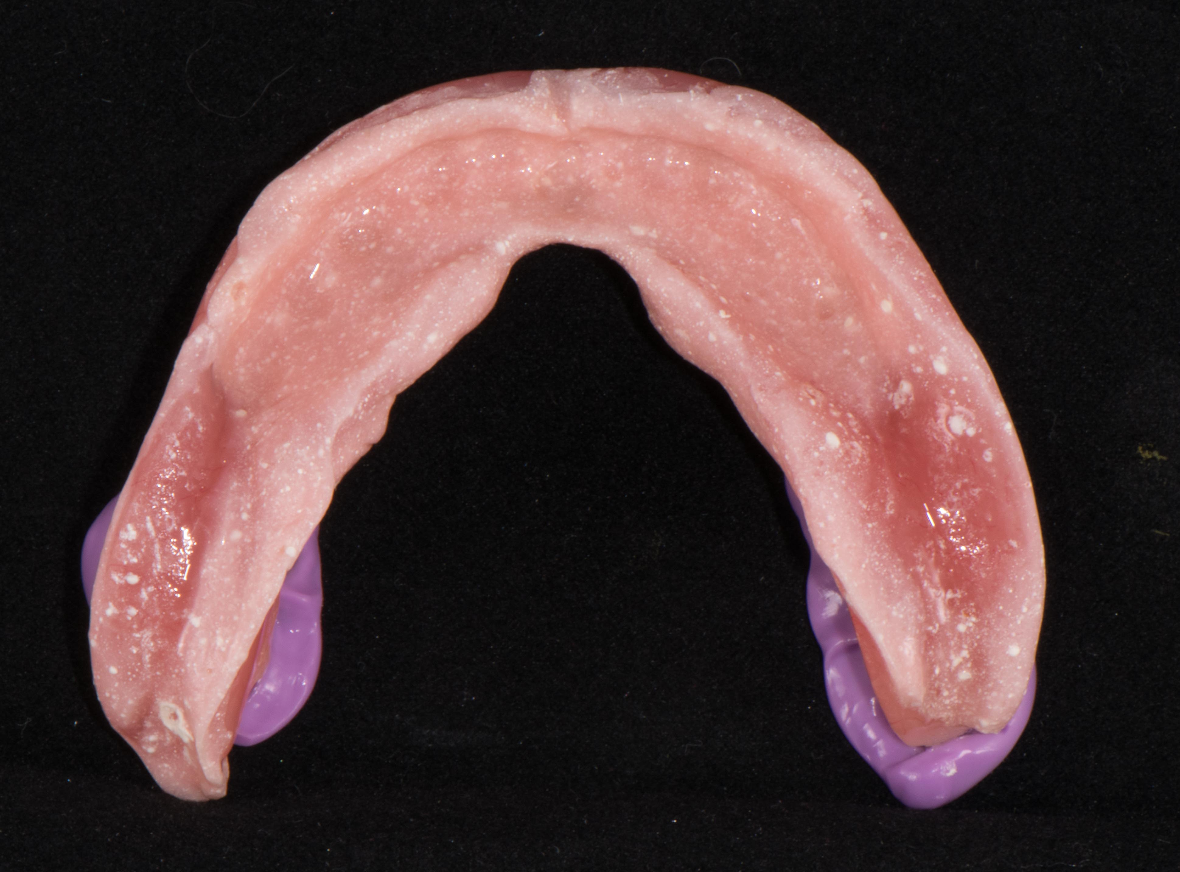 Dental News - Straumann Pro Arch concept with fully guided implant and ...