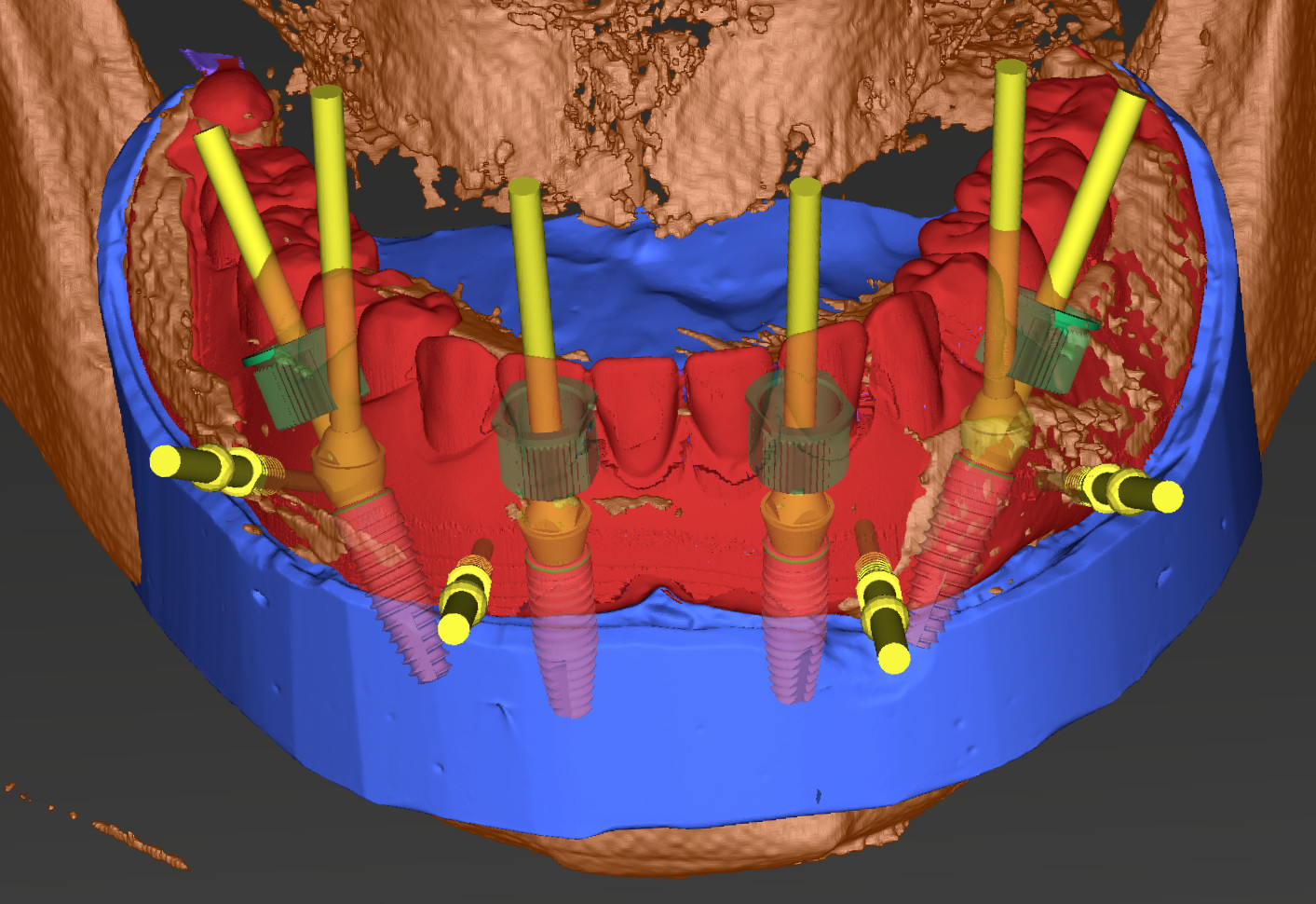 Dental News - Straumann Pro Arch concept with fully guided implant and ...