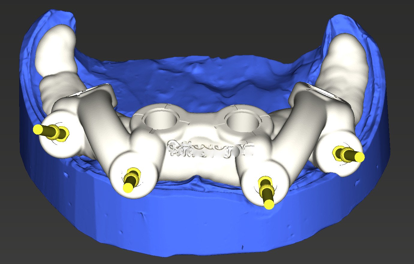 Dental News - Straumann Pro Arch concept with fully guided implant and ...