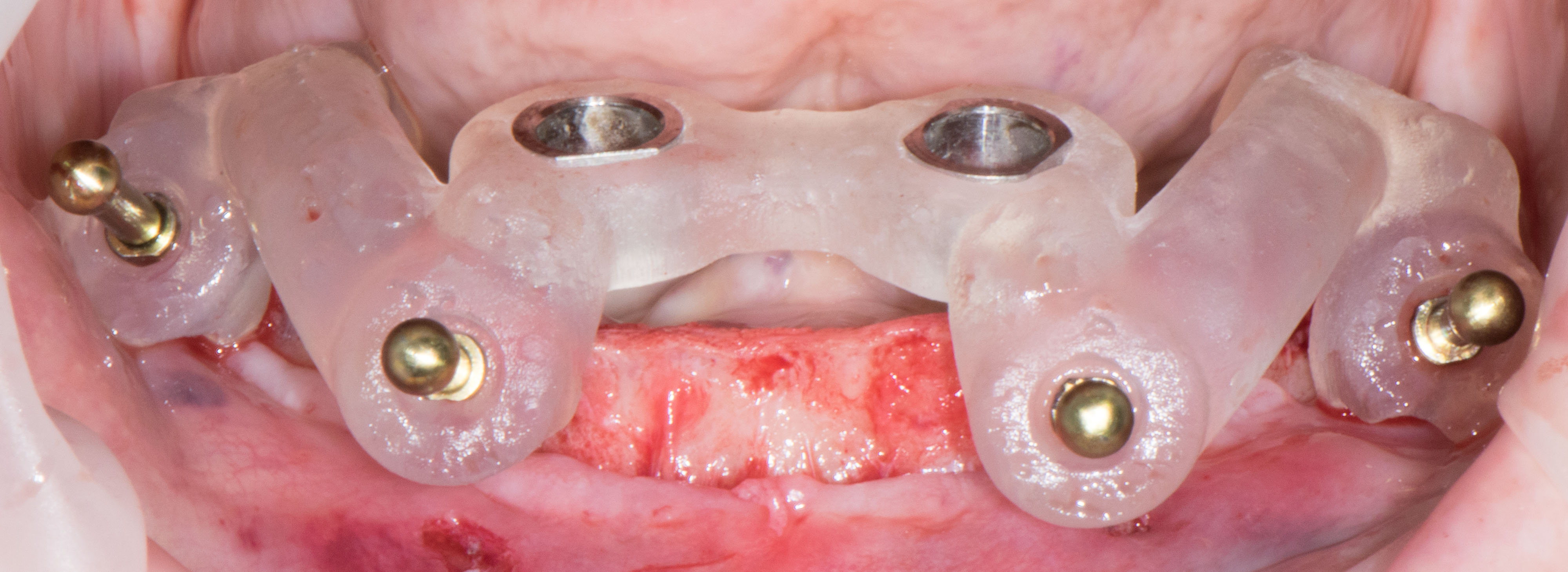 Dental News - Straumann Pro Arch concept with fully guided implant and ...