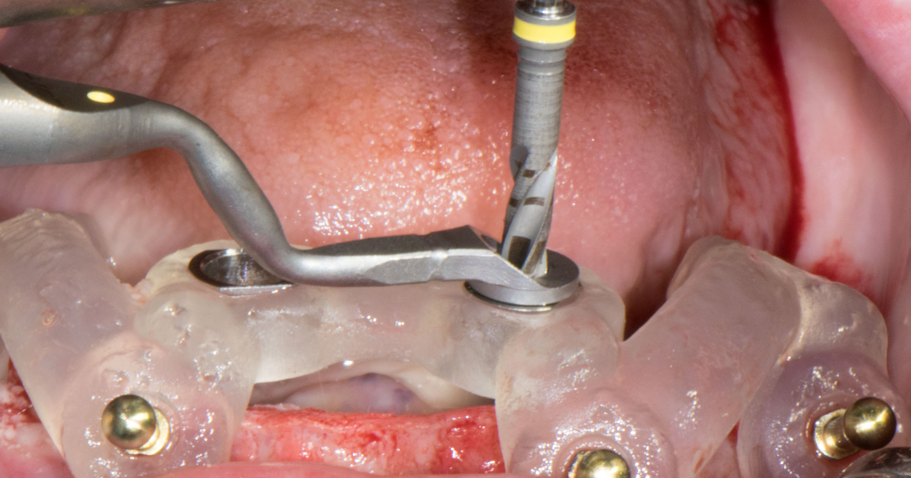 Dental News - Straumann Pro Arch concept with fully guided implant and ...