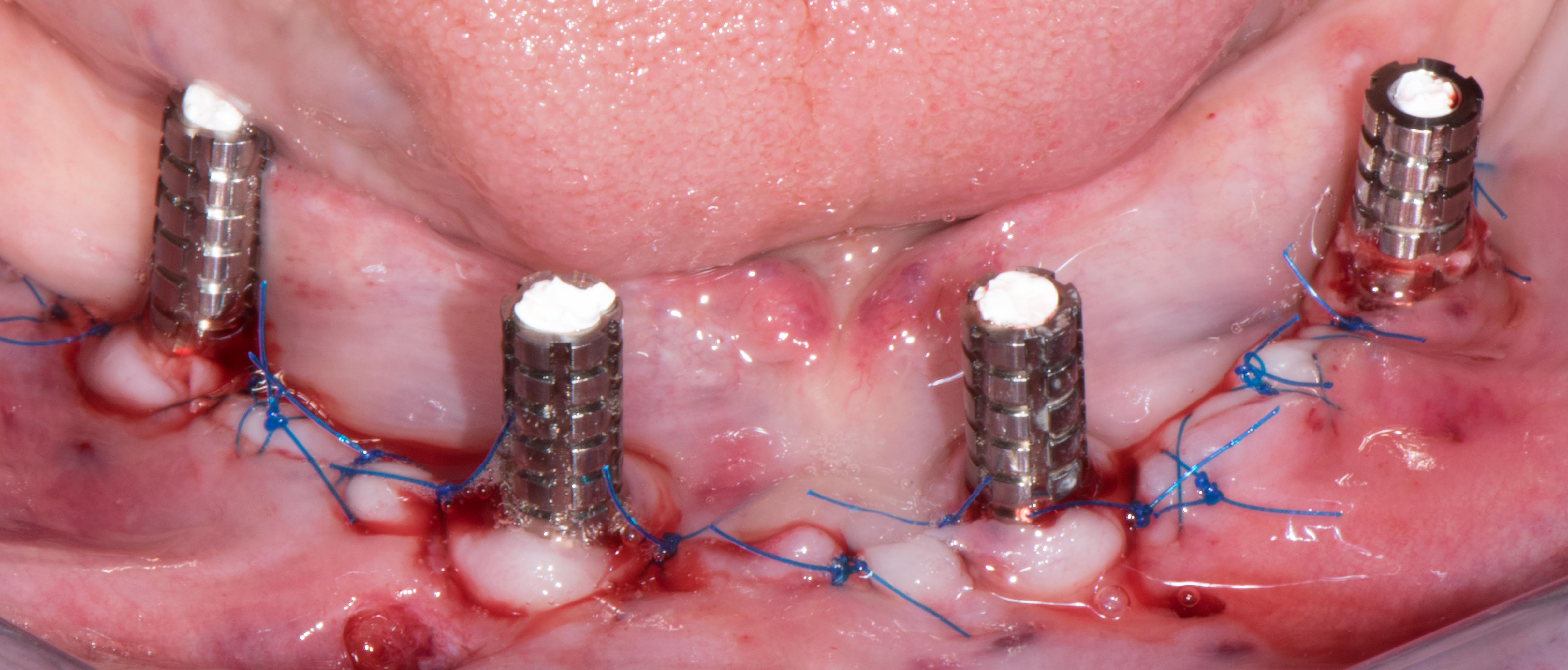 Dental News - Straumann Pro Arch concept with fully guided implant and ...