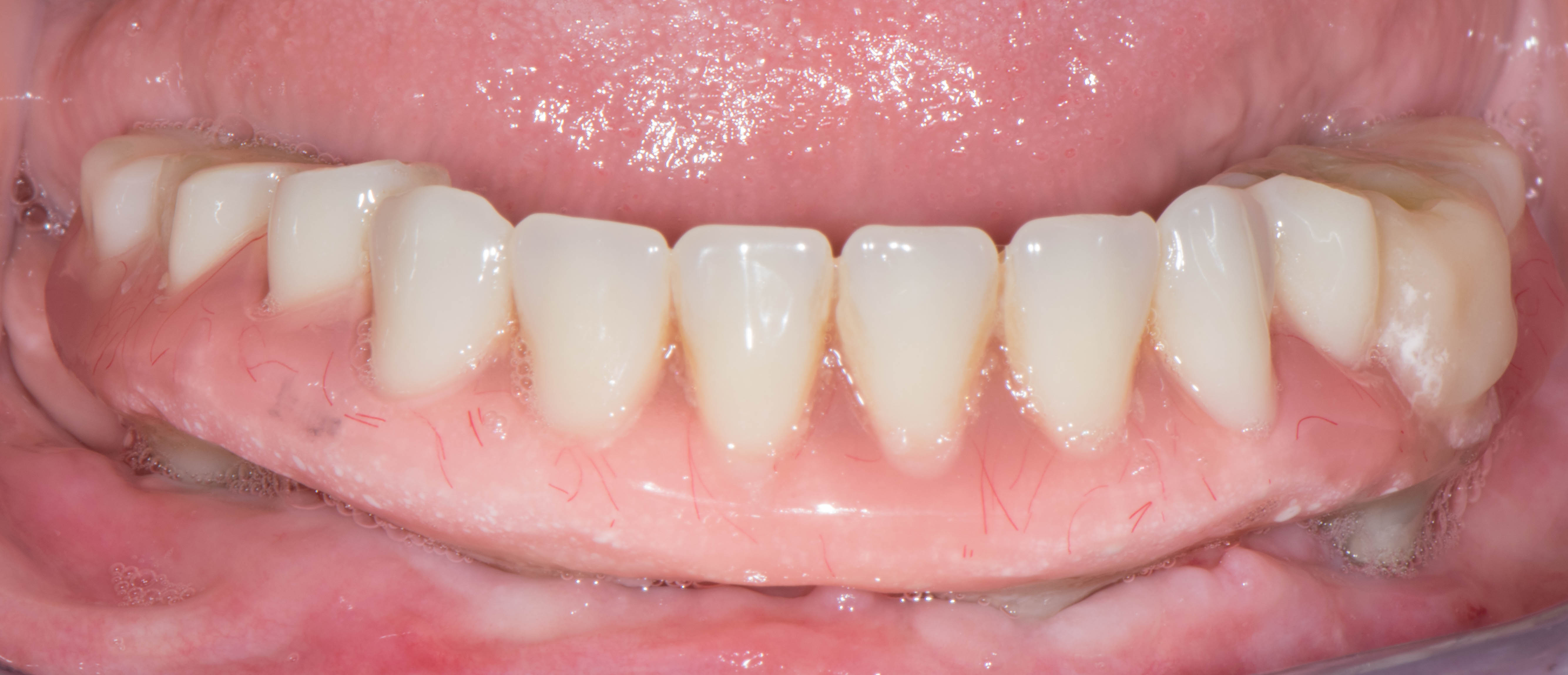 Dental News - Straumann Pro Arch concept with fully guided implant and ...