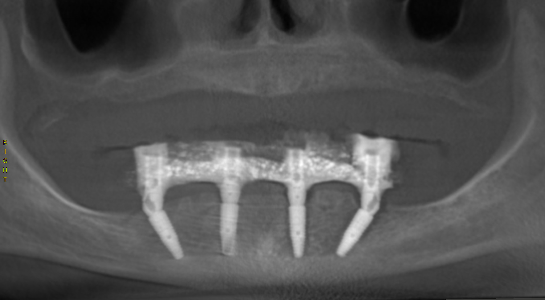 Dental News - Straumann Pro Arch concept with fully guided implant and ...