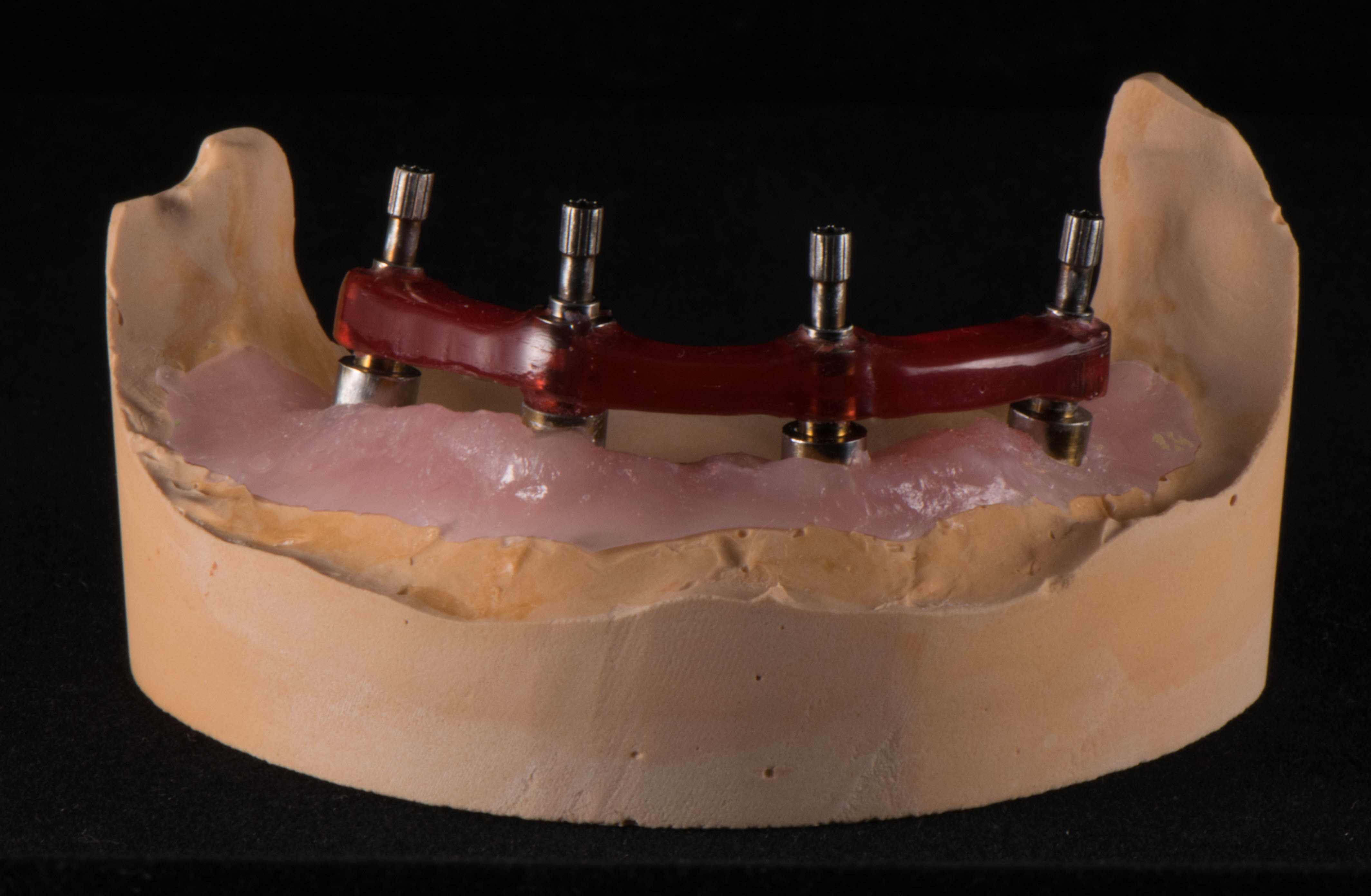 Dental News - Straumann Pro Arch concept with fully guided implant and ...