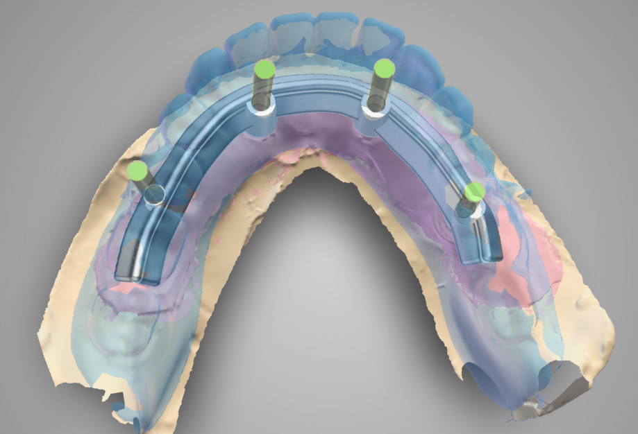 Dental News - Straumann Pro Arch concept with fully guided implant and ...