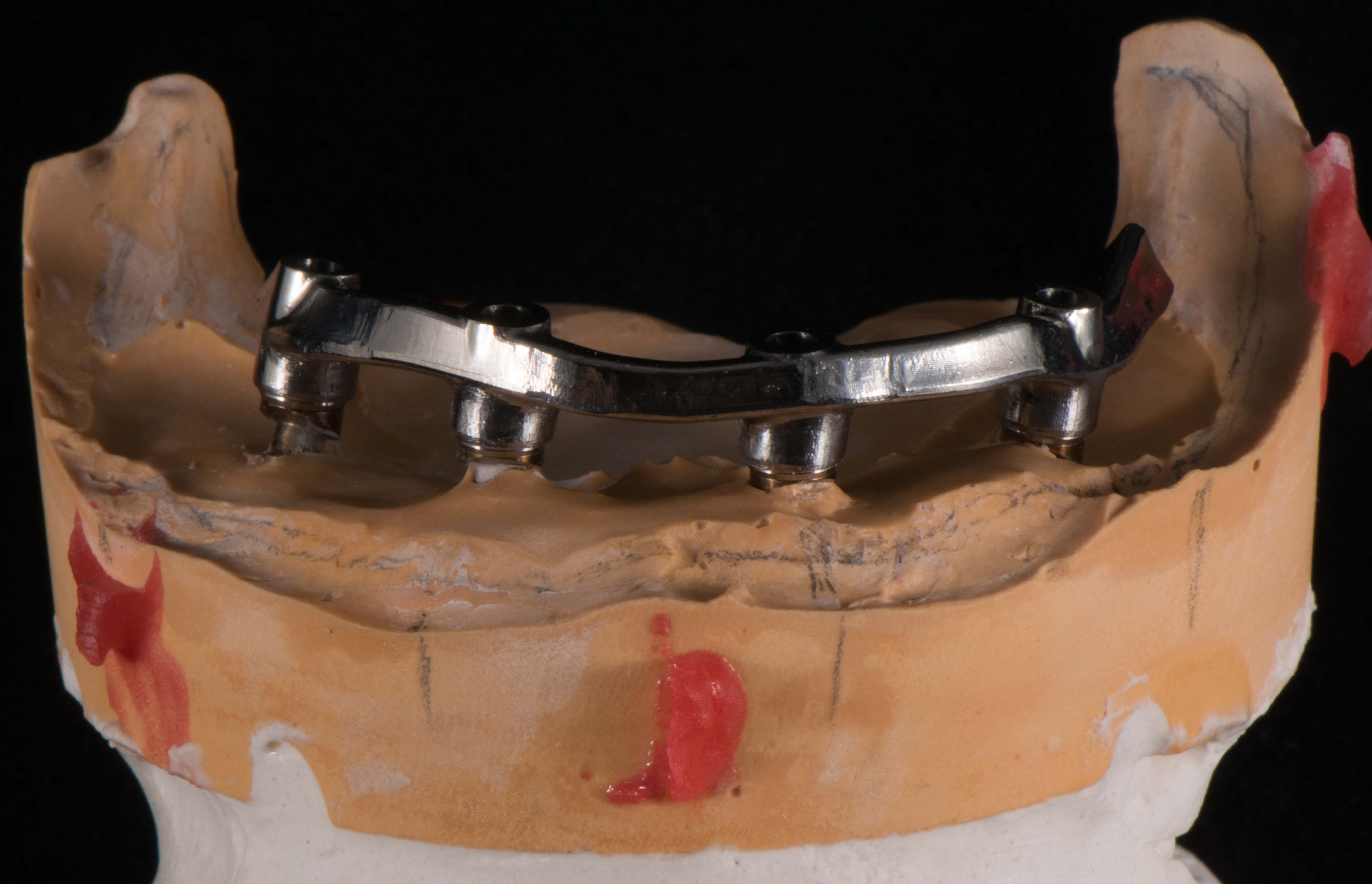 Dental News - Straumann Pro Arch concept with fully guided implant and ...