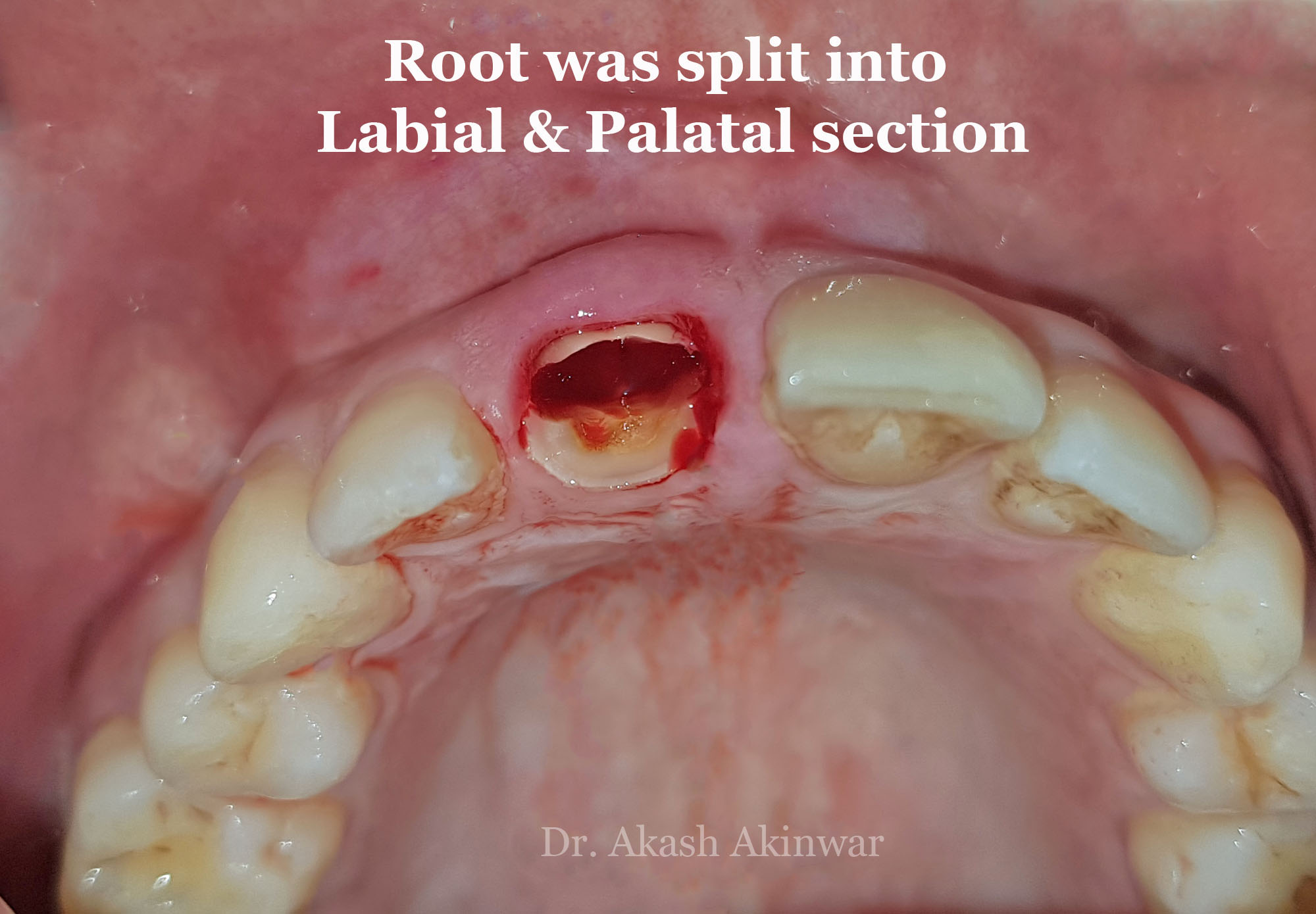 DT News - India - Immediate Implant Placement with Socket Shield ...