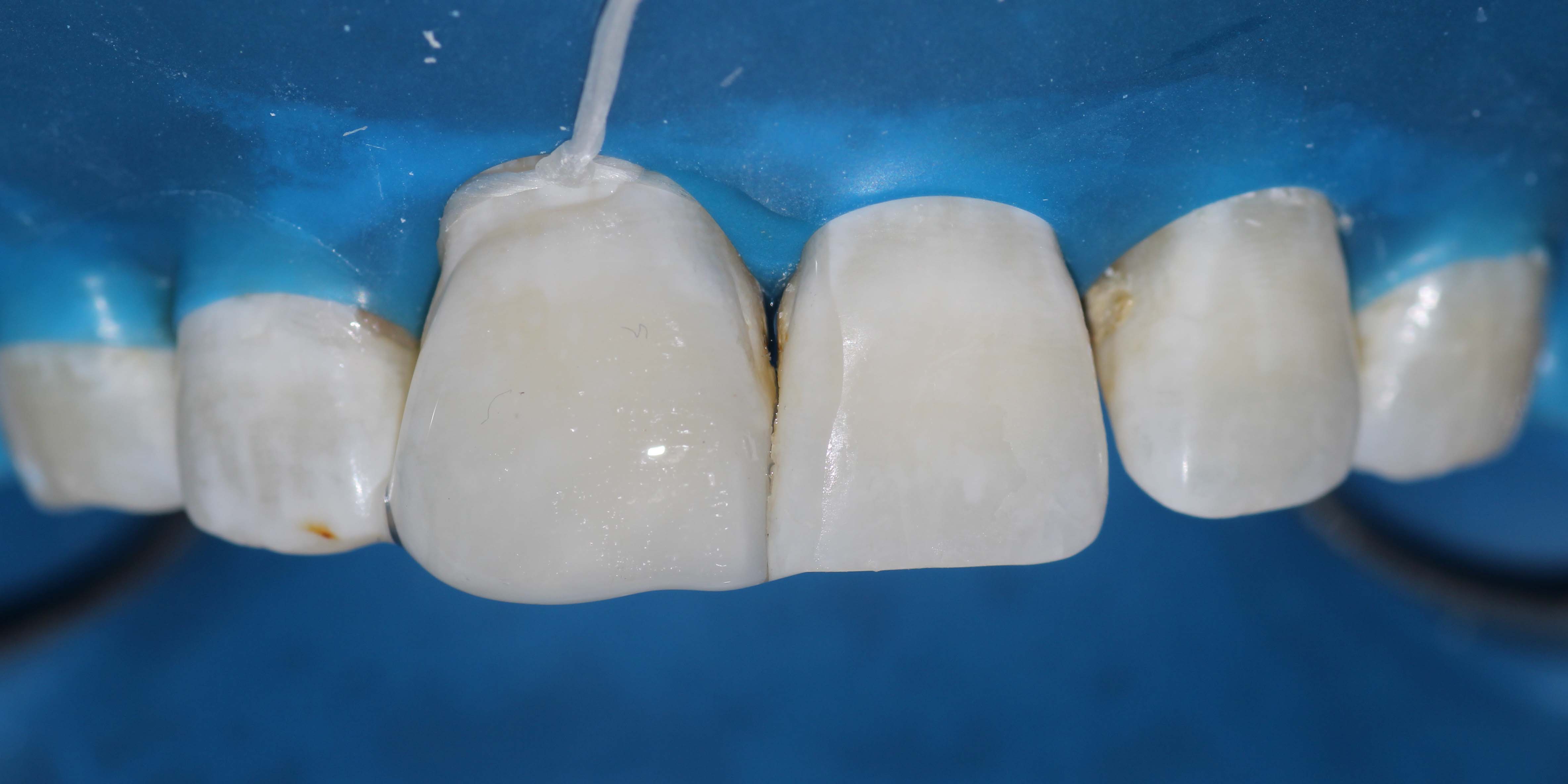 DT News - India - Developing tight proximal contacts in anterior teeth ...