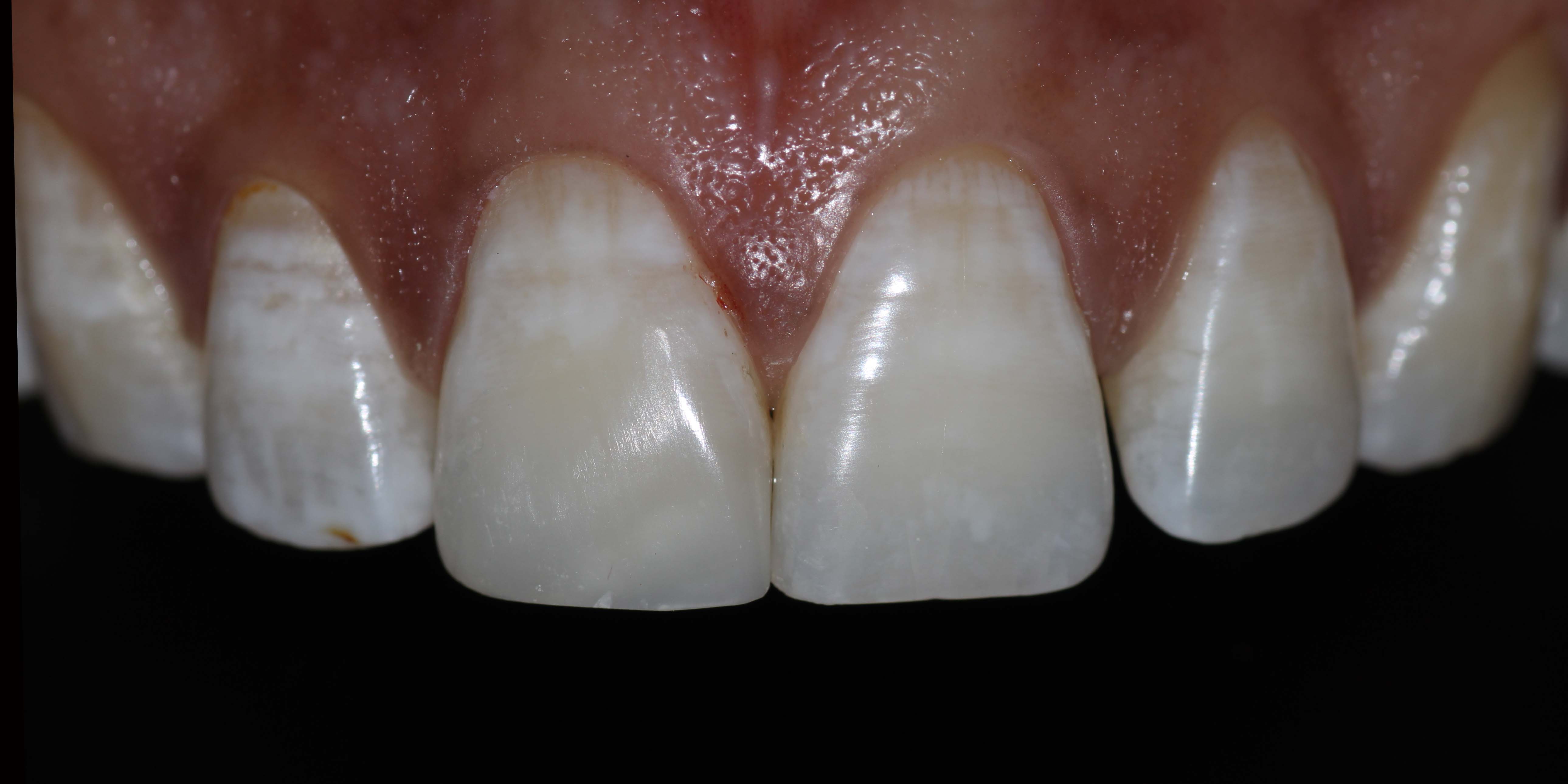 DT News - India - Developing tight proximal contacts in anterior teeth ...