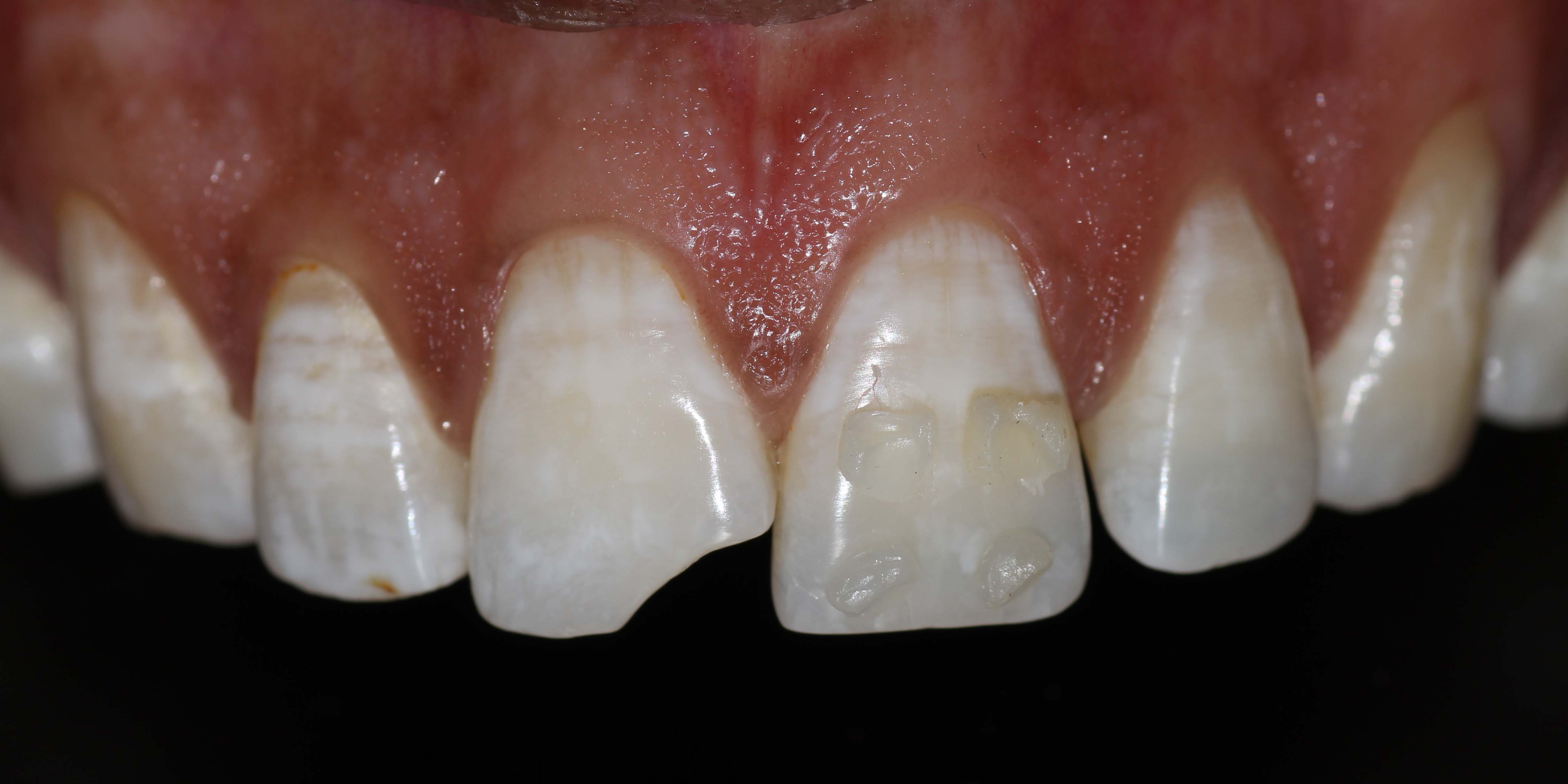DT News - India - Developing tight proximal contacts in anterior teeth ...